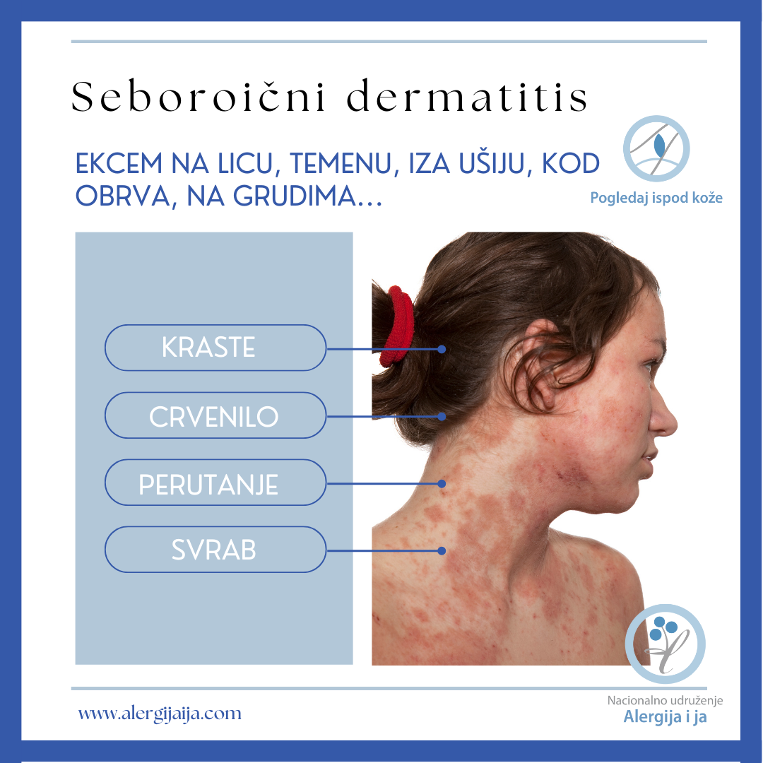 Atopijski ekcem na temenu glave - Alergija i ja
